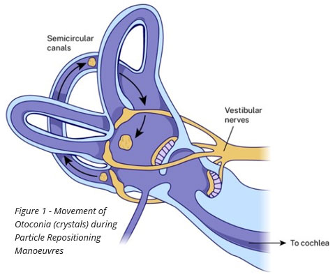 BPPV Physiotherapy Melbourne | Therapy Treatment Options